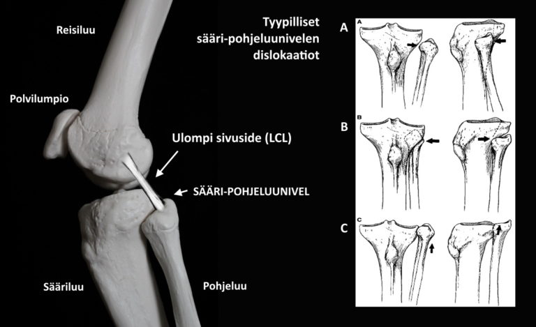 [:fi][:fi]Polvikipu ja polven nivelrikko[:] - Jalatja Healing ...