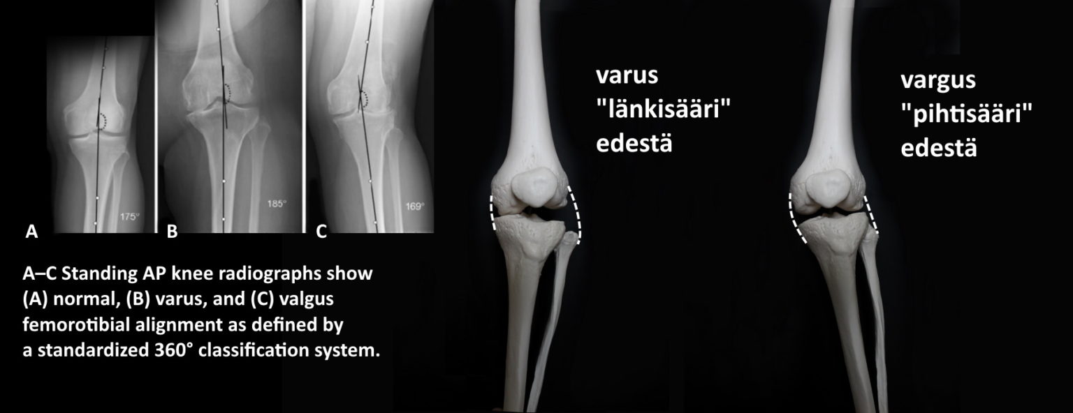 [:fi][:fi]Polvikipu ja polven nivelrikko[:] - Jalatja Healing ...